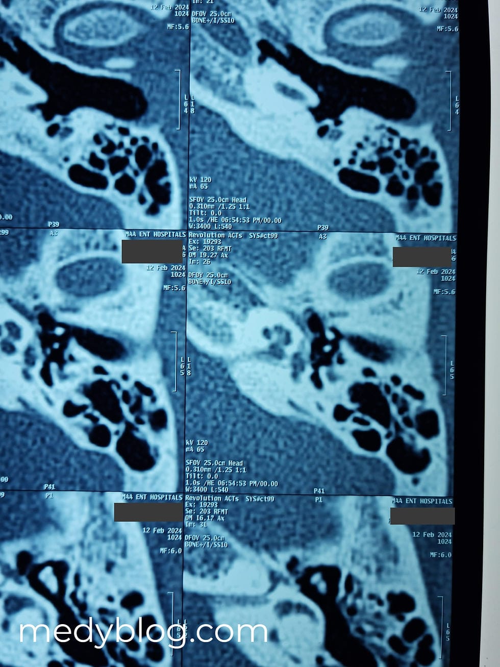 Hueso Compacto vs. Esponjoso: Guía Completa