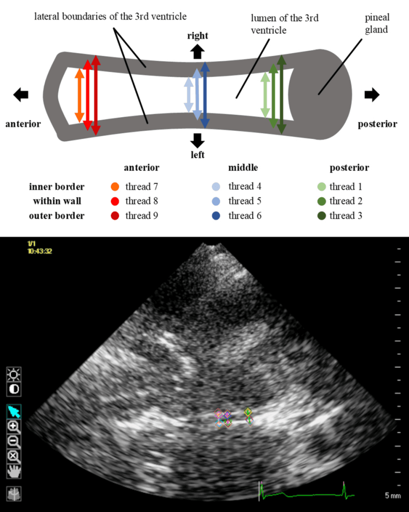 Inter vs. Intra: Prefijos Inter y Prefijos Con Intra